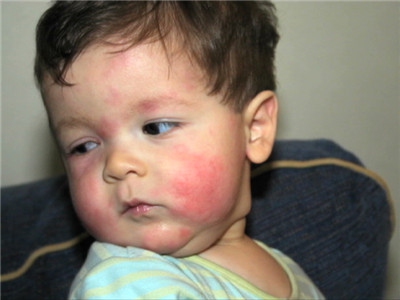 7 Possible Causes of Red Line in Your Skin - EnkiVeryWell