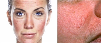 7 Possible Causes of Red Line in Your Skin - EnkiVeryWell